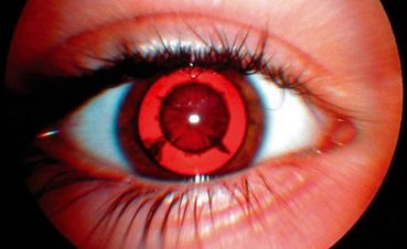 Symptômes et évolution de la Kérato-conjonctivite phlycténulaire ...