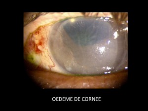Xérosis de la cornée et dystrophie d'origine vasculaire - Ophtalmologie