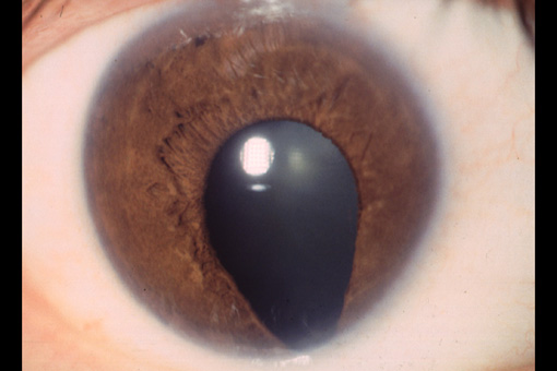 Affection congénitale de l'iris - Ophtalmologie