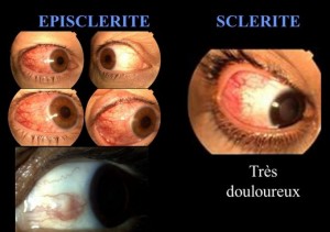 Inflammation de la sclérotique épisclérite sclérite - Ophtalmologie