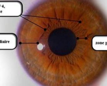 Cataractes congénitales - Ophtalmologie