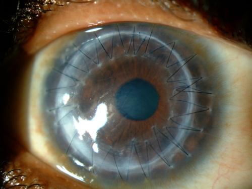 La kératite disciforme - Ophtalmologie