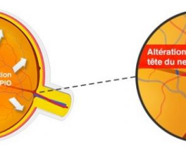 Les formes cliniques du glaucome - Ophtalmologie