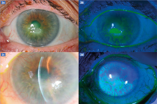 La perforation de la cornée et de ses conséquences - Ophtalmologie