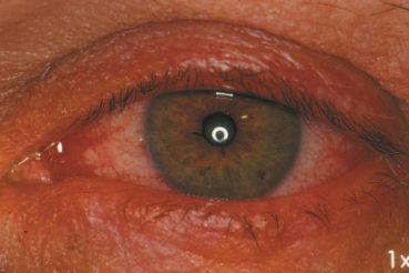 L'épisclérite - Ophtalmologie