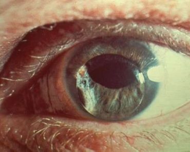 Cataractes traumatiques - Ophtalmologie