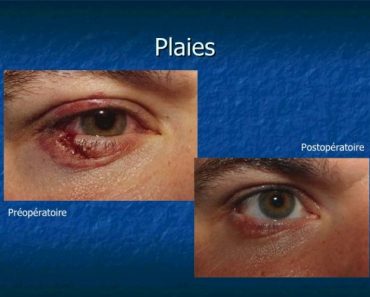 Conjonctivite gonococcique de l'adulte - Ophtalmologie