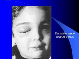 La fistule lacrymale et son traitement - Ophtalmologie