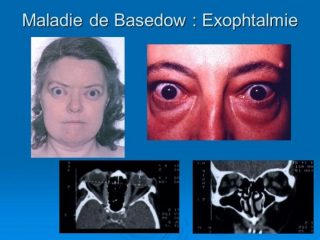 Méthodes d'examen d'affections de l'orbite - Ophtalmologie