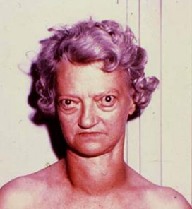 Les verres astigmates - Ophtalmologie