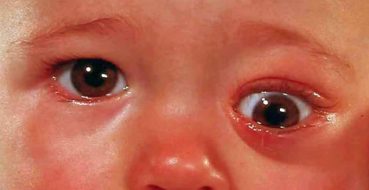 L'exophtalmie et diagnostic différentiel - Ophtalmologie