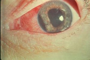 Iridodialyse traumatique et inversion de l'iris - Ophtalmologie