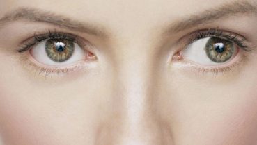 Le strabisme divergent - Ophtalmologie