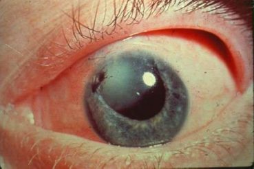 Altérations du cristallin - Ophtalmologie