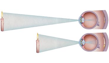 Paralysie de la convergence - Ophtalmologie