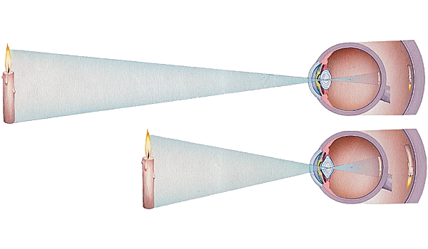 Paralysie de la convergence - Ophtalmologie