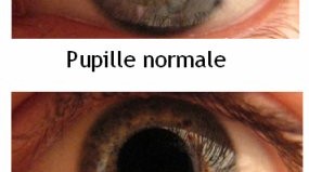 Le trouble du réflexe photo-moteur - Ophtalmologie