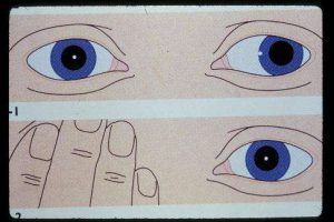 L'hétérophorie - Ophtalmologie