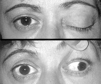 Méthode d'examen de la pupille anormale - Ophtalmologie