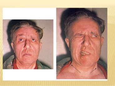 Diagnostic d'une paralysie faciale - Ophtalmologie