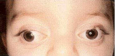 Traitement chirurgical du strabisme convergent - Ophtalmologie