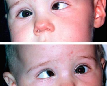 Le réflexe pupillaire à l'état normal - Ophtalmologie