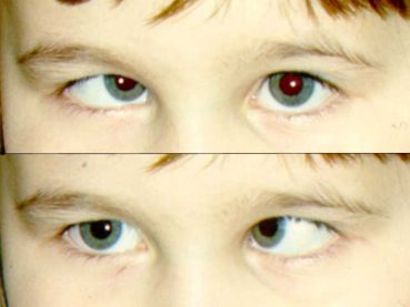 Étiologie et pronostic du strabisme concomitant - Ophtalmologie