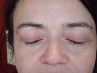 Diagnostic du zona ophtalmique - Ophtalmologie