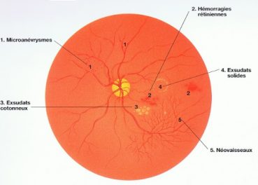 L'ophtalmologiste et la médication vasculaire - Ophtalmologie