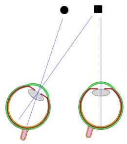 Examen du champ visuelle - Ophtalmologie