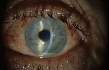 Les injections sous-conjonctivales - Ophtalmologie